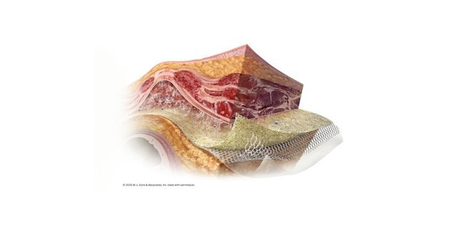 Gore Synecor Intraperitoneal biyomateryali piyasaya sürdü İhlas Haber ...